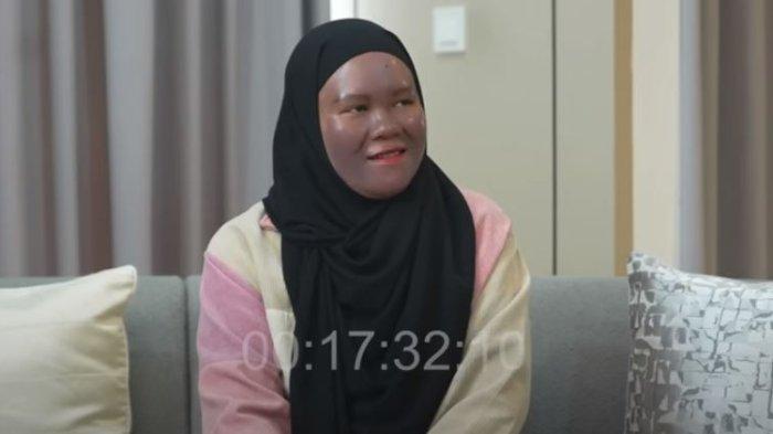 Viral Kisah Wanita Ini Alami Wajah Gosong Gegara Pakai Skincare Merkuri ...