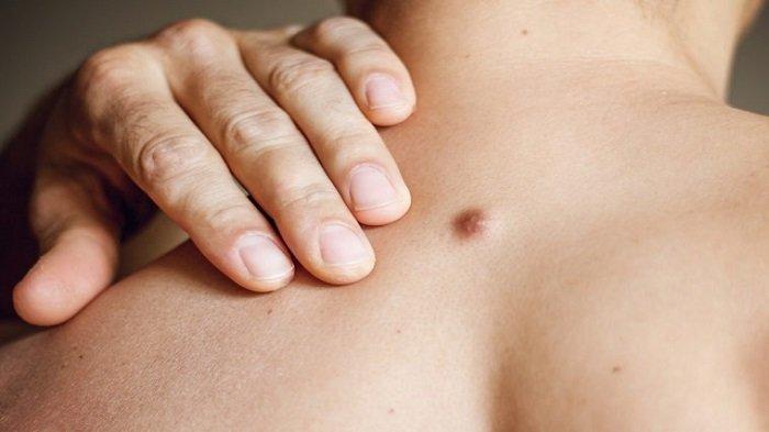 Obat Tradisional Sakit Bisul, Gunakan Bahan-bahan Ini dan Tunggu ...