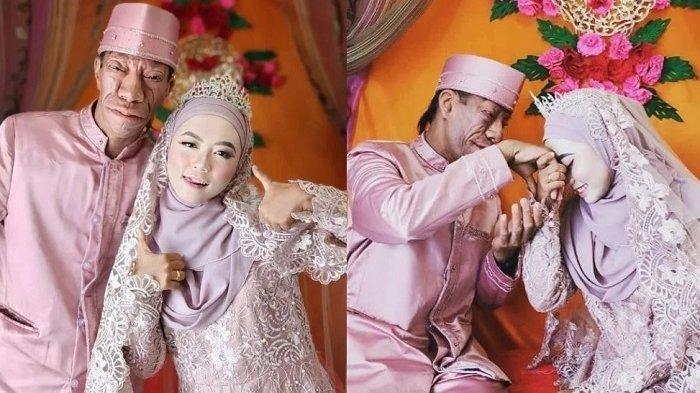Kisah Surya Manurung, Dulu Viral di TikTok Ngidap Sindrom Treacher Collins, Kini Nikahi Gadis ...