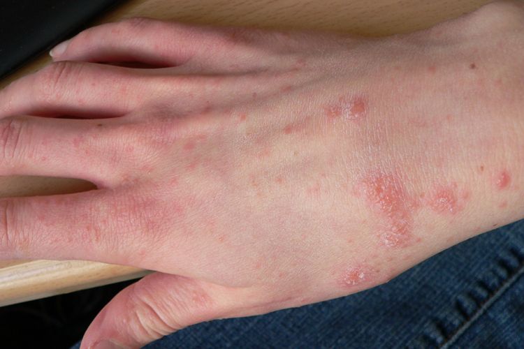 Eksim dan Dermatitis Atopik Bukan Disebabkan Makanan, Ini Penjelasan ...