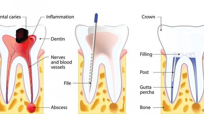 Perawatan Saluran Akar Gigi, Apa Saja Sih Manfaatnya? - Tribunjakarta.com