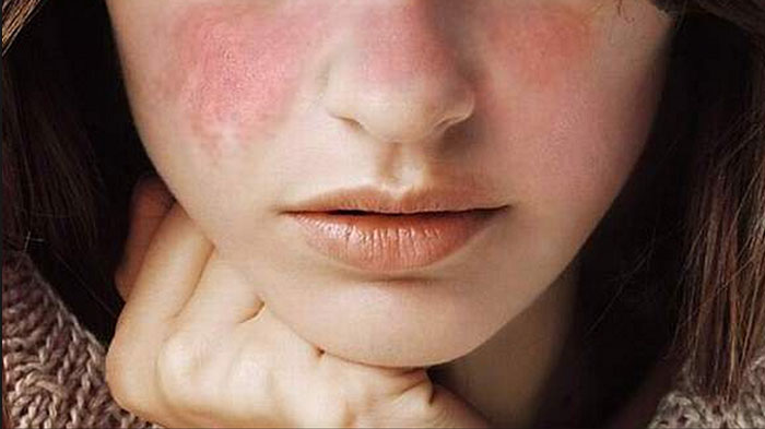 10 Mei Diperingati Hari Lupus Sedunia, Ketahui Tanda dan Gejala ...