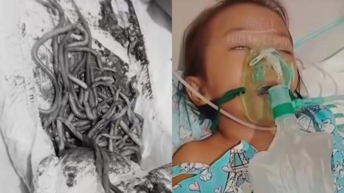 Kasus Raya Meninggal karena Cacingan, Kenali Gejala dan Pencegahannya! - Halaman all ...