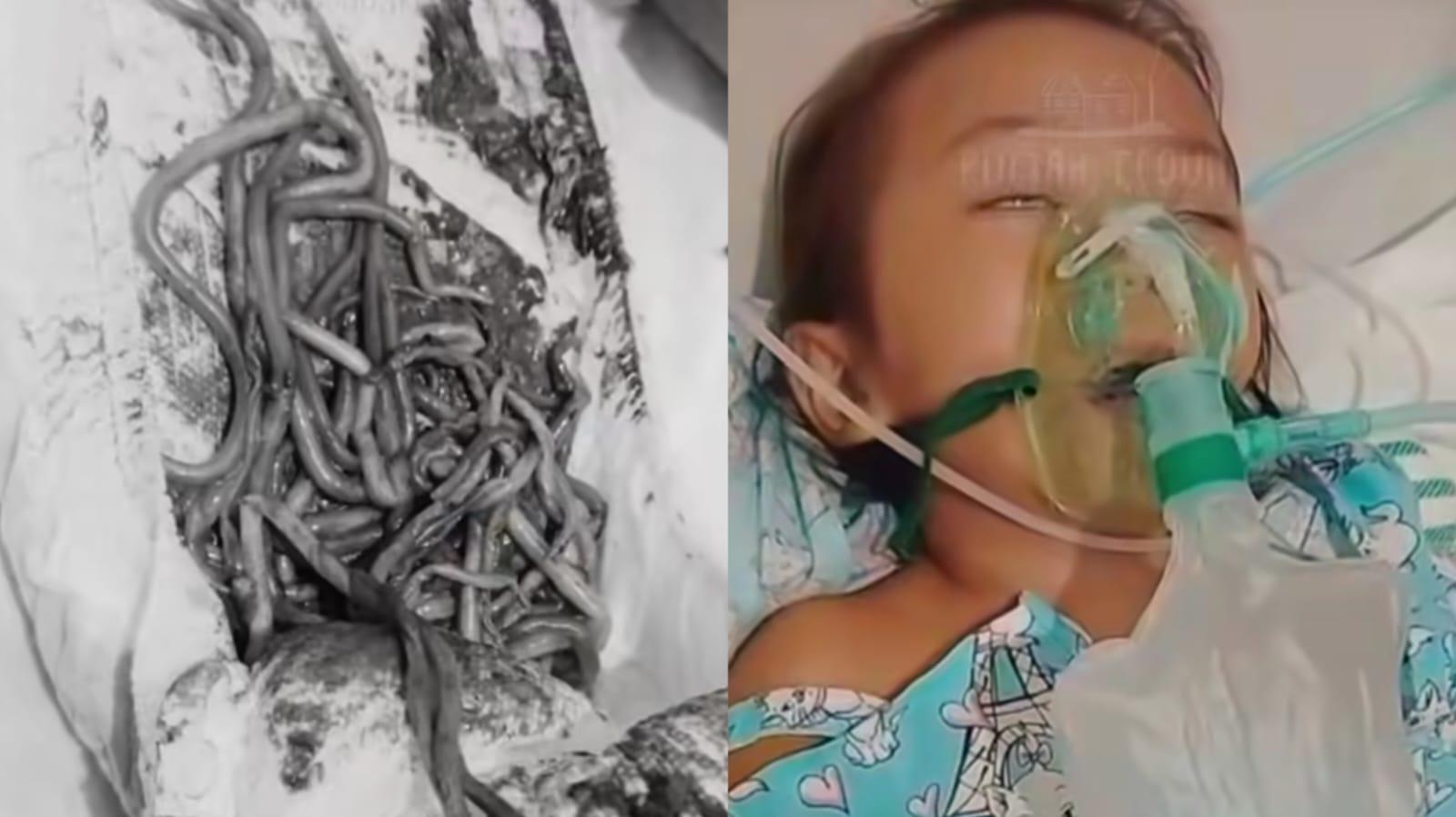 Kasus Raya Meninggal karena Cacingan, Kenali Gejala dan Pencegahannya! - Halaman all ...