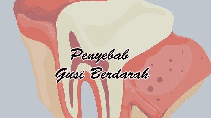 7 Penyebab Gusi Berdarah dan Tujuh Cara Mengatasinya, Simak Penjelasan - Tribunmanado.co.id