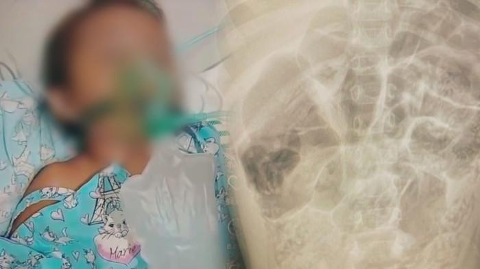 Raya, Balita di Sukabumi Meninggal Akibat Infeksi Cacing Parah, Menyebar hingga Paru-paru dan ...