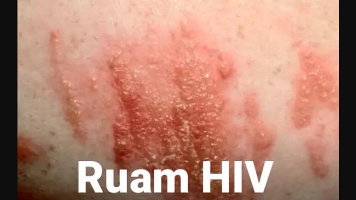 Apa Itu Ruam HIV? yang Bisa Jadi Gejalanya, Berikut Ini Jenisnya ...