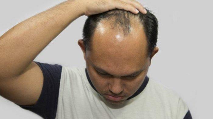Penyebab Botak Depan dan Puncak Kepala pada Pria, Ini Cara Mengatasinya ...