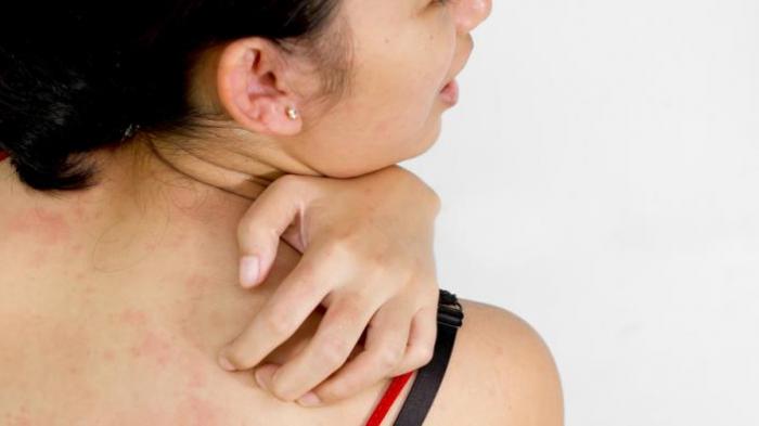 Deteksi Dini, Bercak Kusta pada Tubuh untuk Tangkal Penularan - Sripoku.com