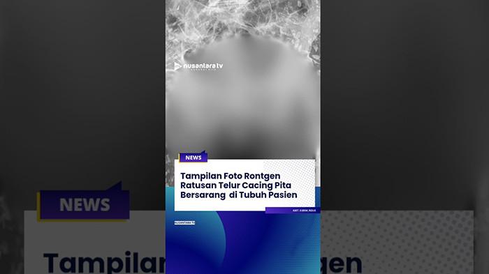 Viral Sinar-X Penuh Telur Cacing Pita, Parasit Mematikan Itu Bersarang ...