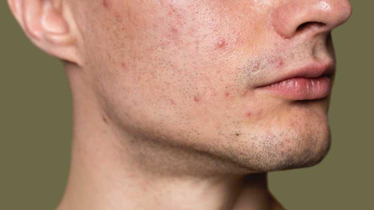4 Rekomendasi Serum untuk Bekas Jerawat Hitam Mulai 30 Ribuan ...