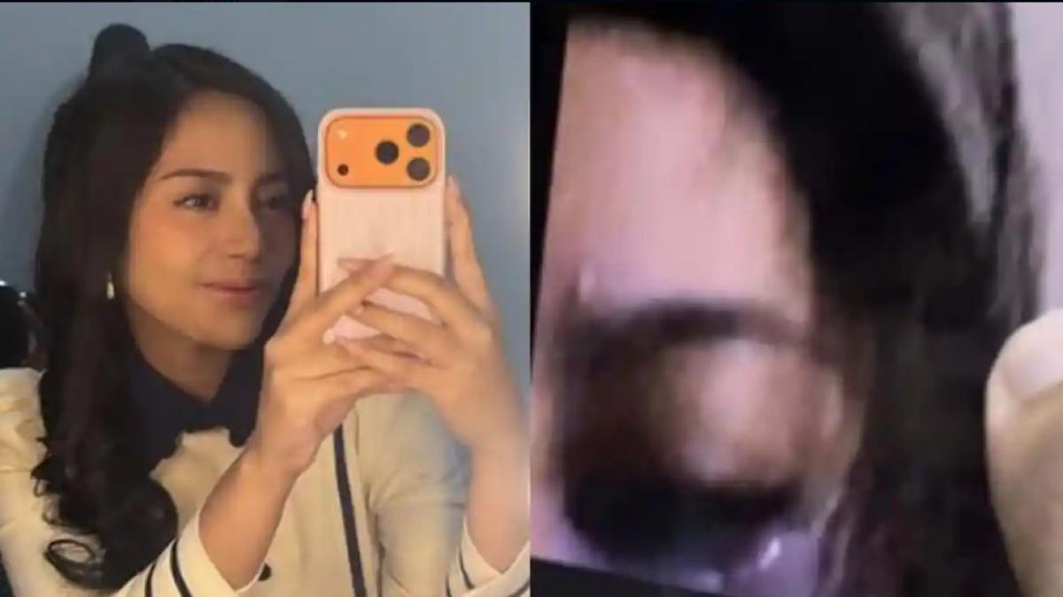 Mata Kiri Rachel Vennya Jadi Sorotan, Foto Lebam Ramai Dibahas di Media ...