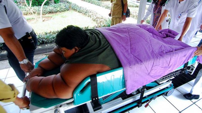 Arya Permana - Berbobot 190 kg, Dokter Ungkapkan Nyawa Bocah Ini Bisa ...