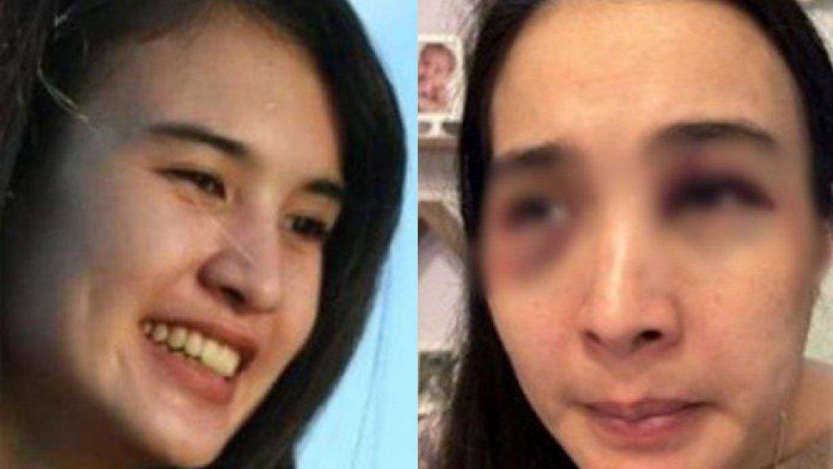 Sama-sama Tersangka KDRT, Suami Putri Balqis Tak Ditahan, Izin Operasi Alat Vital, Mertua ...