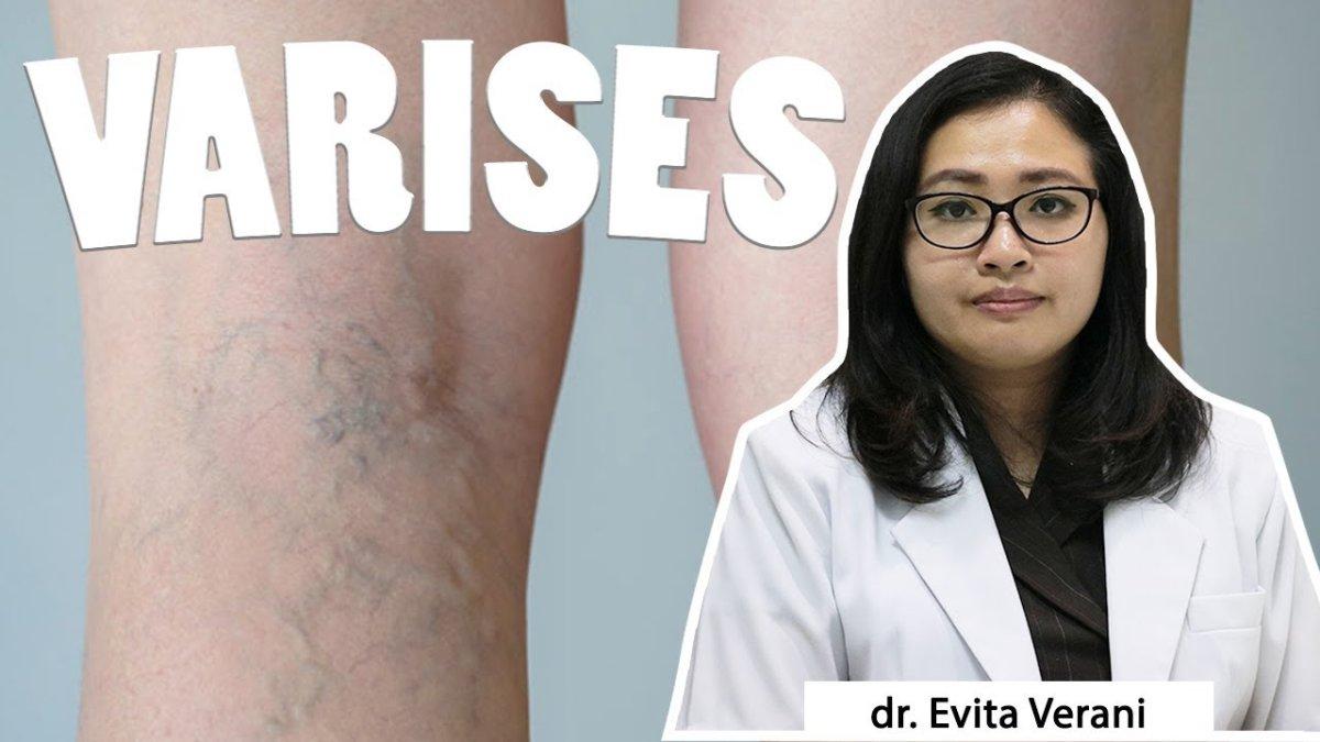 5 Cara Mengobati Varises Secara Alami Hindari Penggunaan Pakaian Ketat ...