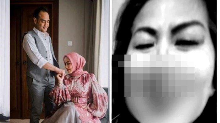 Beredar Foto Diduga Wajah Venna Melinda Berlumuran Darah Alami KDRT Ferry Irawan, Polisi Ungkap ...