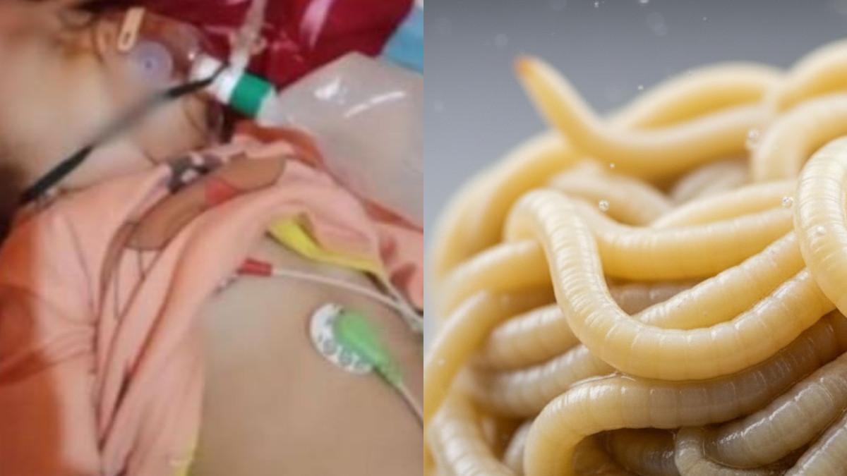 Cacing Gelang Keluar dari Mulut Hidung Bocah di Bengkulu, Ternyata Perut Ada Gumpalan Diduga ...