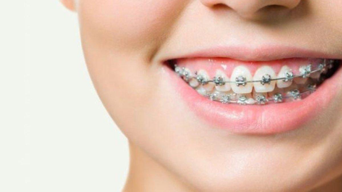 Manfaat dan Pentingnya Memasang Behel Gigi di Klinik Gigi Damessa - TribunTrends.com