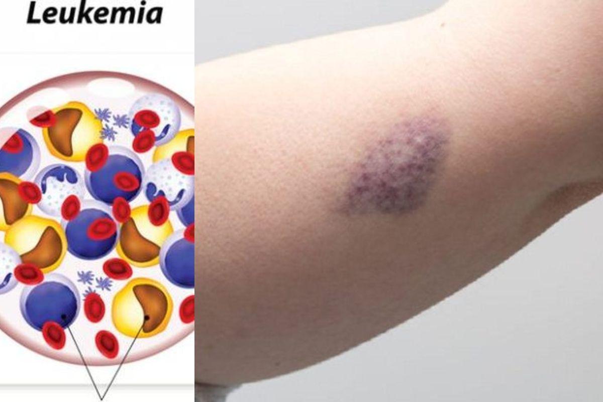 Mengenal Leukemia, Penyakit Kanker Sel Darah Putih yang Paling Sering ...
