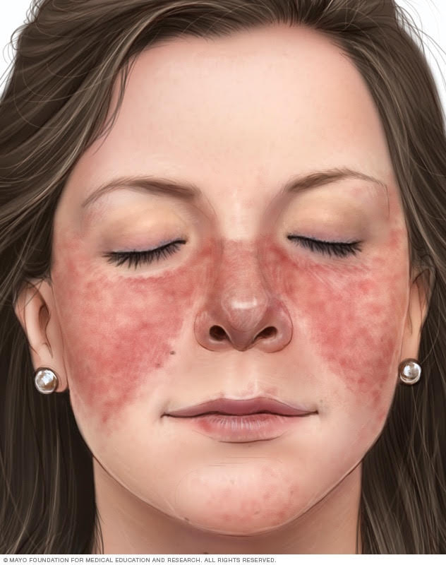 Mengenal Penyakit Lupus, Berikut Gejala dan Penyebabnya - Halaman all ...