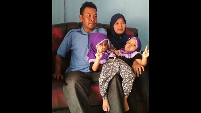 Sempat 'Disembunyikan' Ayahnya, Kembar Siam Asal Garut Kini Tumbuh Jadi Bocah Periang! - Tribun Wow